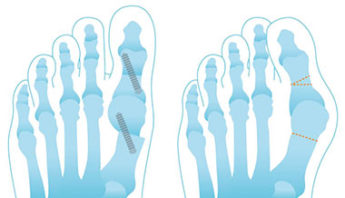Traitements pied - CRCO - Centre Rochelais de Chirurgie Orthopédique